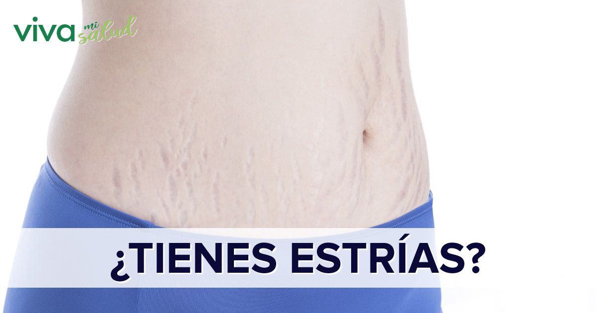 Estrías: ocho datos que debes conocer